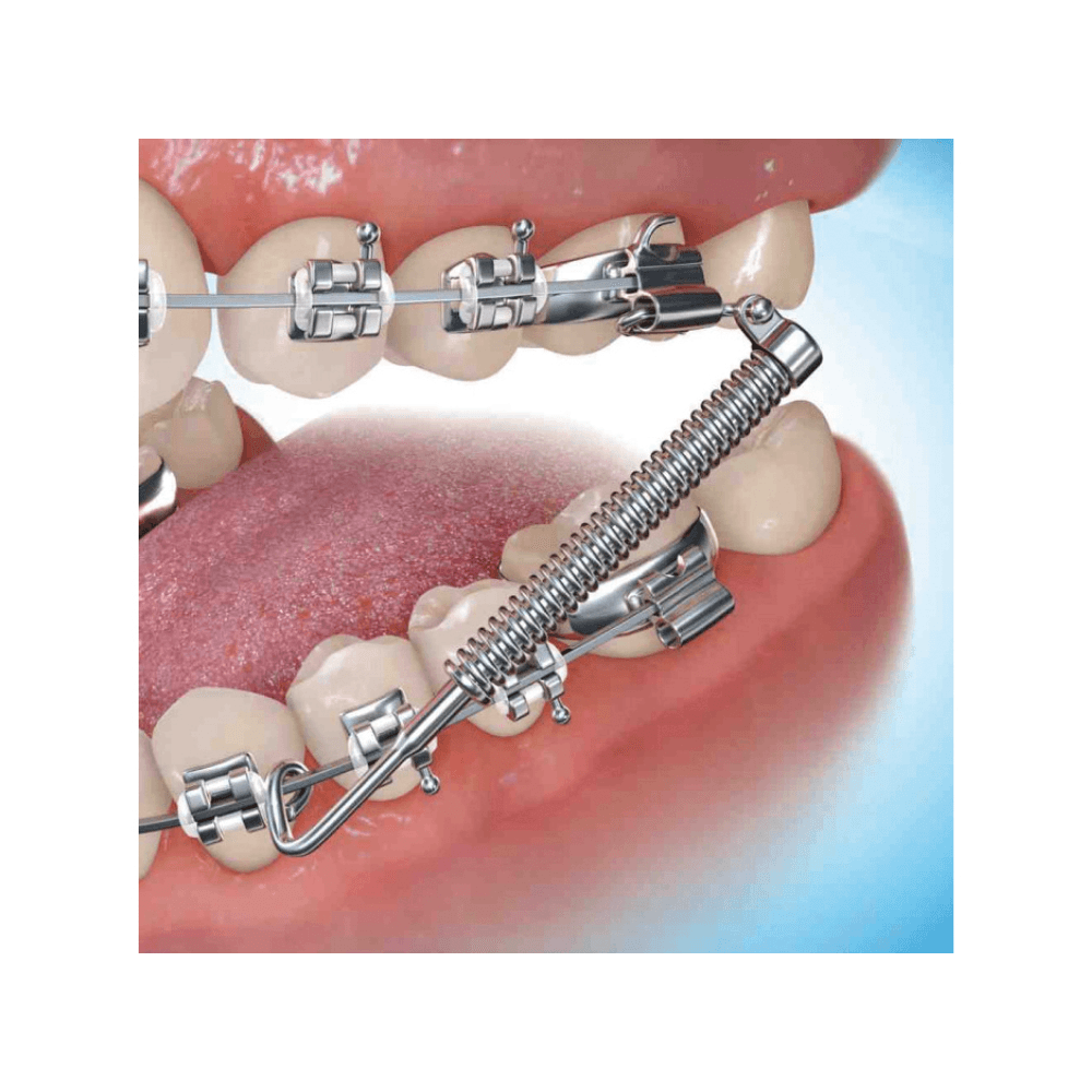 Corretor de Classe II 3M Forsus L-Pin - Solventum - dentalecia