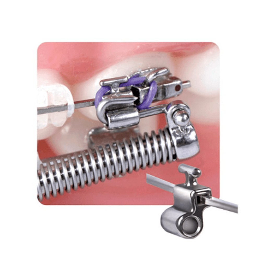 Corretor de Classe II 3M Forsus L-Pin - Solventum - dentalecia