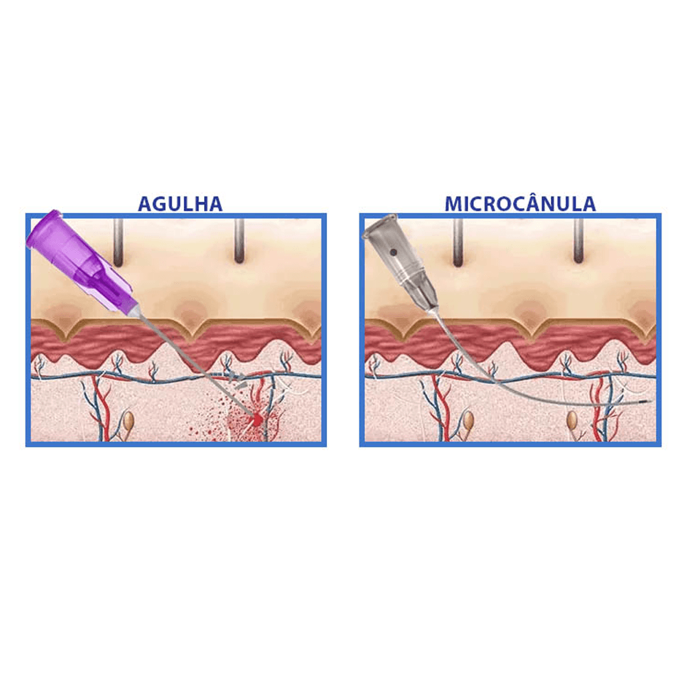 Microcânula Slim Bico de Pato - Fabinject - dentalecia